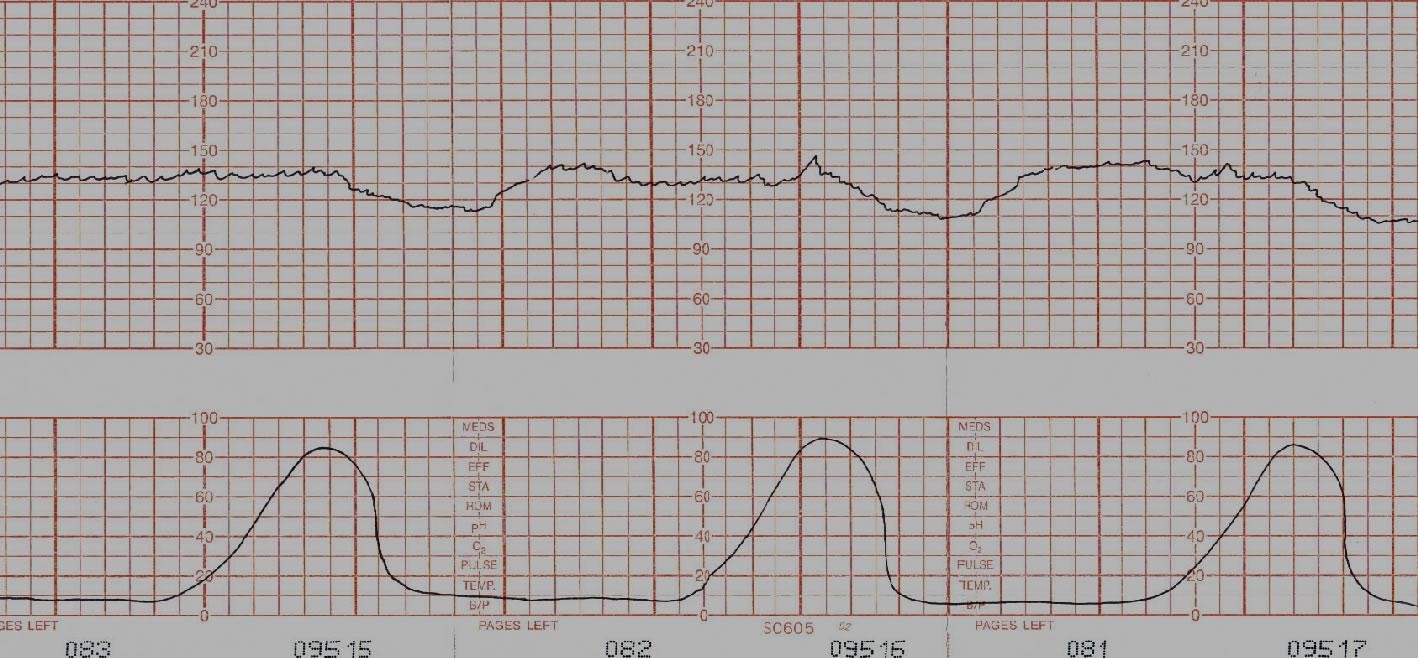 Fetal Monitor Strip 2