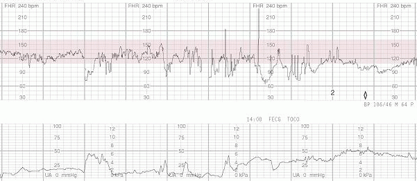 Fetal Monitoring Strip 3